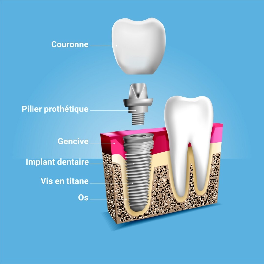 Implants Dentaires Dentist Marrakech My Smile Implants Dentaires Dentist Marrakech My Smile